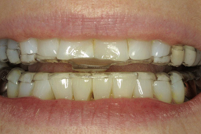 Fabricating Splints in the Office | Inside Dentistry