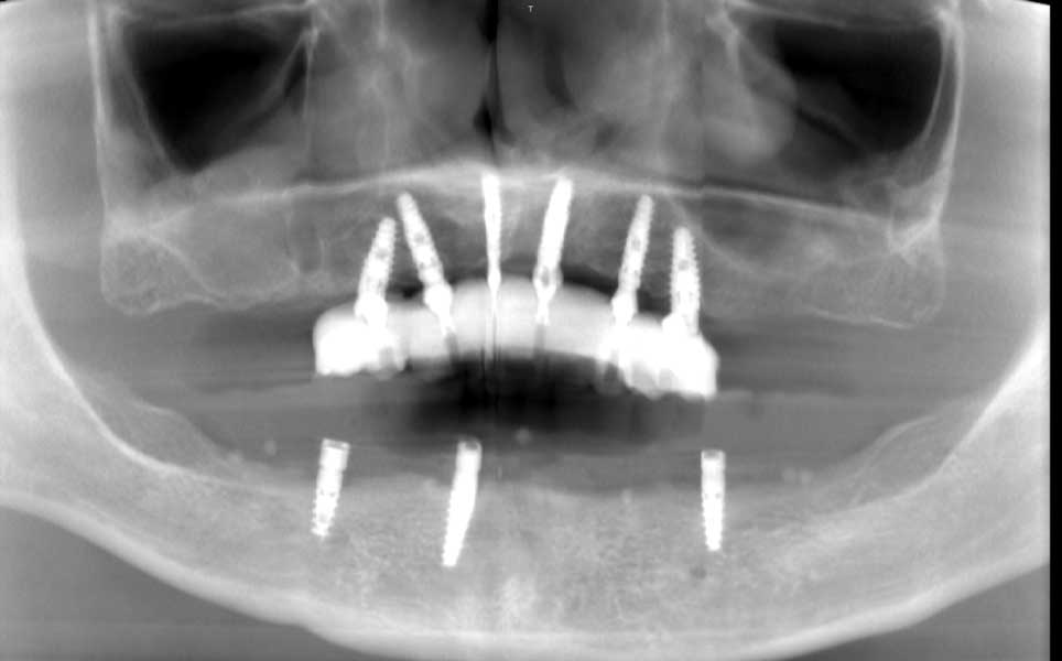 Single-Visit Full-Arch Implant-Supported Prostheses | Inside Dentistry