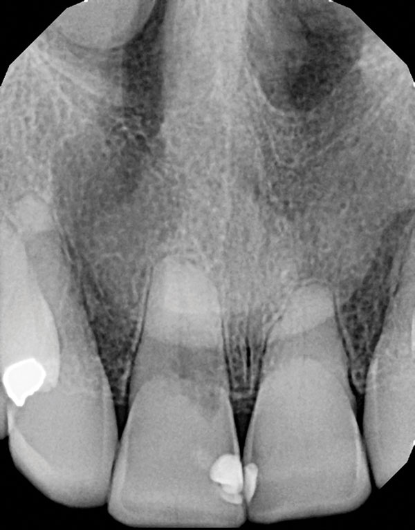 Improving the Esthetics of Single Tooth Implant Restorations in the ...