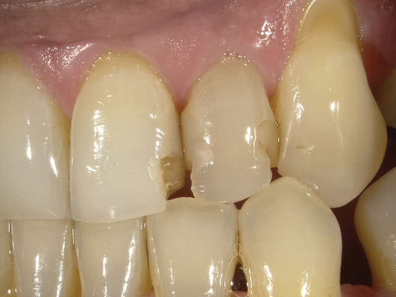 Re-treating Failed Anterior Direct Composite Restorations | Inside ...
