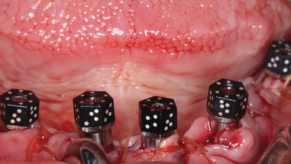 Intraoral Photogrammetry and Facial Scanning for Full-Arch Implant ...