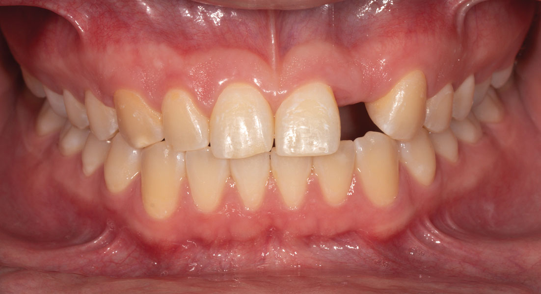 Delivering a Zirconia Resin-Bonded Fixed Partial Denture | Inside Dentistry