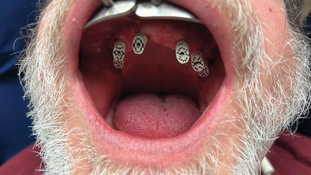 The Advantages of Photogrammetry in Implant Dentistry | Inside Dentistry