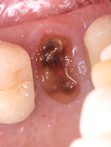 Alveolar Ridge Preservation via Socket Grafting | Inside Dentistry