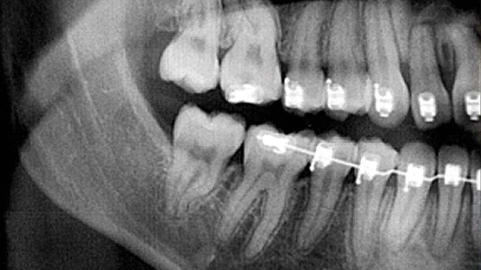 Biomimetic Restoration of a Maxillary First Molar | Inside Dentistry