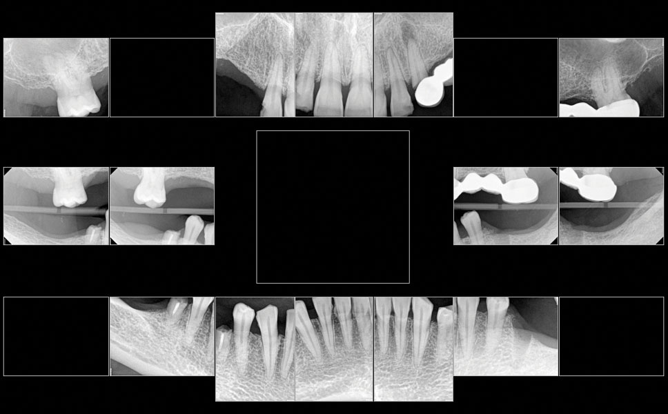 Digital Full-Arch Maxillary Rehabilitation | Inside Dentistry