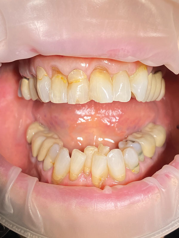 Correcting Soft-Tissue Deficiencies Without Surgery | Inside Dentistry