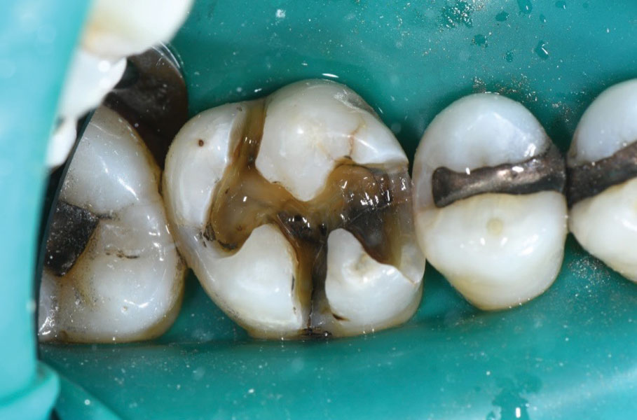 Replacing a Posterior Amalgam Restoration With Composite | Inside Dentistry