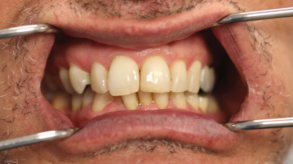 Anterior Tooth Replacement for a Periodontally Compromised Patient ...